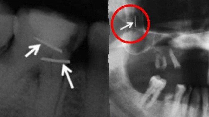 Awalnya Ngeluh Sakit Gigi, Dokter Syok Temukan Dua Jarum Besar di ...