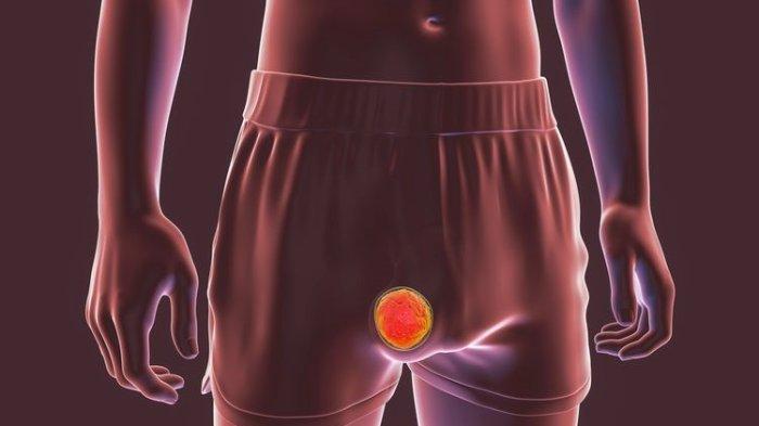Kaum Pria Jangan Sepelekan Tumor Testis Ini 4 Gejala Dan Penyebabnya