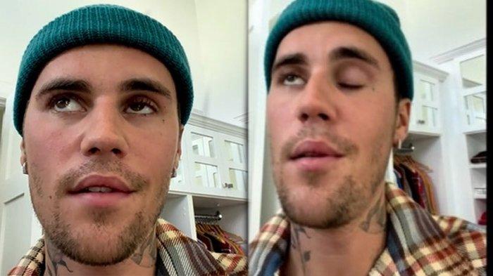 Ramsay Hunt Syndrome Penyebab Wajah Justin Bieber Lumpuh, Ini Bedanya ...