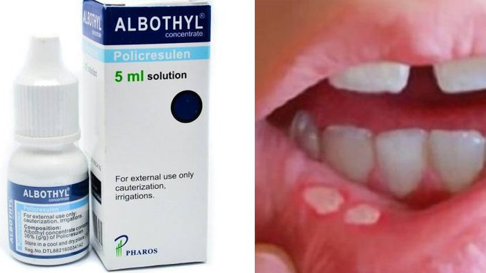 Heboh Obat Sariawan Albothyl Berbahaya, Ini Penjelasan BPOM, Dokter ...