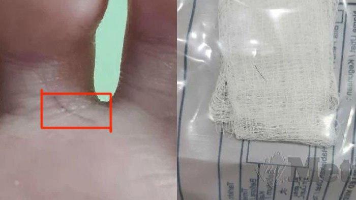 Dokter Bedah Kaki Bocah Temukan Sehelai Rambut Bergerak Sendiri, Diduga ... Dokter Bedah Kaki Bocah Temukan Sehelai Rambut Bergerak Sendiri, Diduga ...
