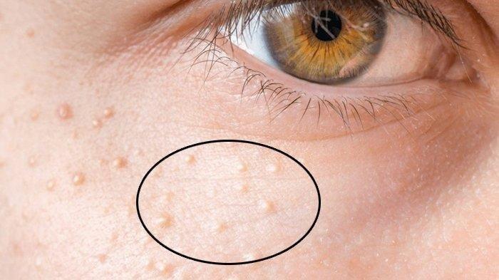 5 Cara Mudah Menghilangkan Bintil-bintil Putih di Kulit Wajah, Lakukan ...