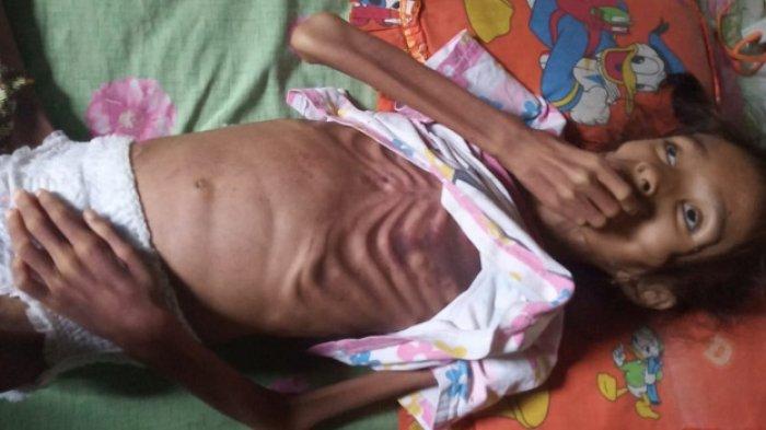 Tolong! Pasien Kanker Usus Asal Simeulue Berharap Bantuan, Fisiknya ...