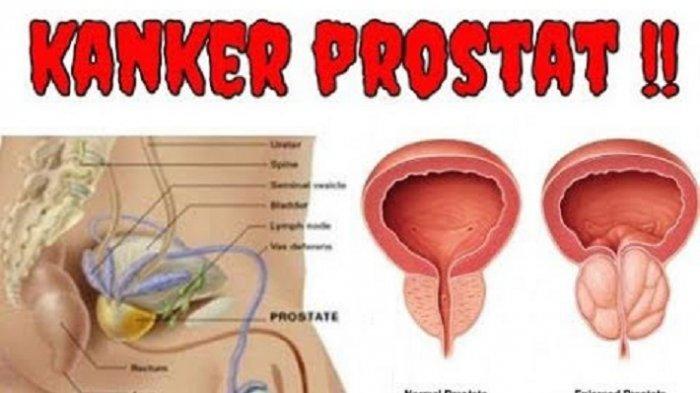 Mengenal Risiko Kanker Prostat, Begini Cara Ampuh untuk Mencegahnya Sejak Dini - Serambinews.com