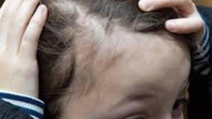 Bunda, Kenali Penyebab Rambut Rontok pada Anak dan Begini Cara ...
