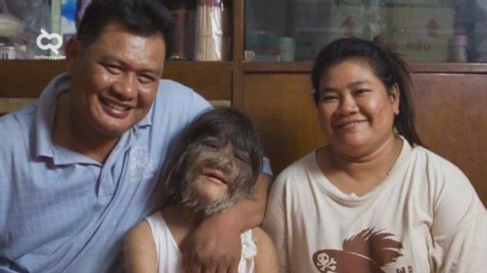 Masih Ingat Gadis yang Dulu Viral karena Wajah Penuh Bulu? Kini Sudah ...