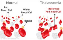Mengenal Thalassemia - Serambinews.com