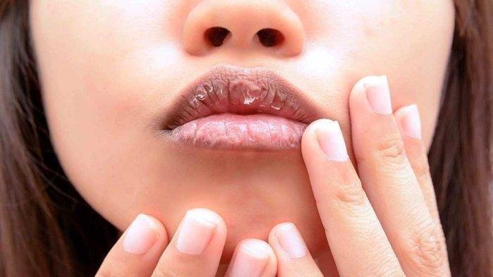 Kenali 6 Penyebab Bibir Kering, Nomor 2 dan 3 Sering Diabaikan ...