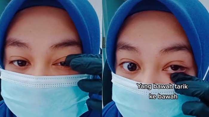 VIRAL Kucek Mata Bukan Solusi Atasi Gatal, Disebut Bisa Buat Kornea ...