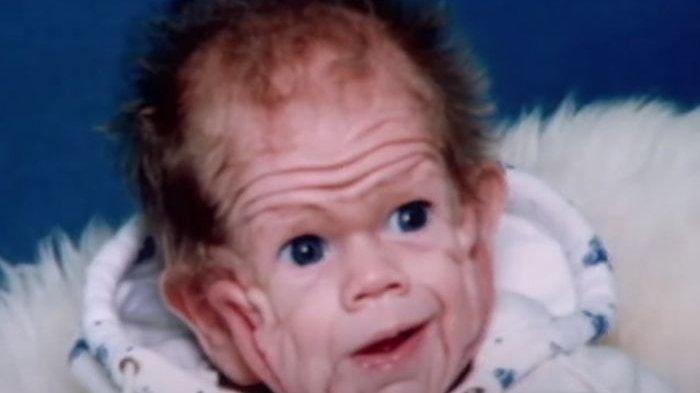 Bayi Ini Dulu Terlahir dengan Kulit Keriput Bak Kakek-kakek, Kini ...