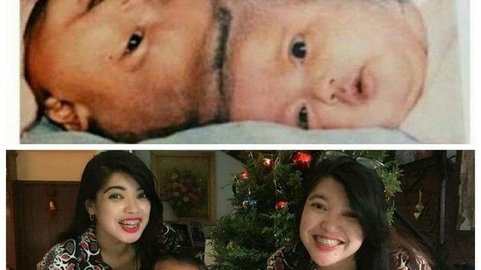 Yuliana dan Yuliani, Anak Kembar Siam Dempet Kepala, Kini Jadi Dokter dan Doktor - Serambinews.com