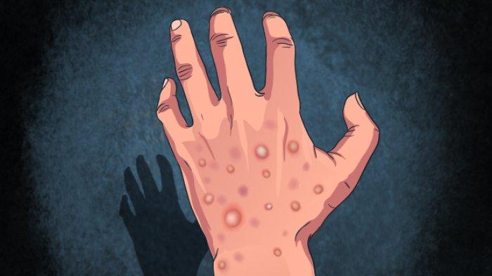 ATENSI Cacar Monyet! Dinkes Badung Siapkan Ruang Isolasi Kasus Mpox ...