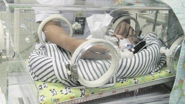 Bayi Kembar Parasit Asal Buleleng Yang Memiliki Empat Tangan Sudah ...