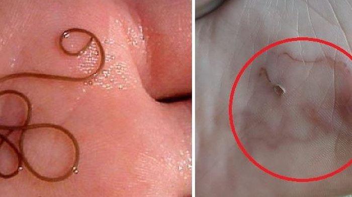 Kaki Nurul Kemasukan Cacing Saat Main di Pantai, Setiap Malam Terasa ...