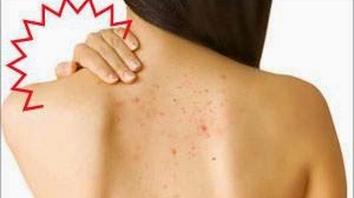 Cara Mengatasi Ketidak Nyamanan Dan Nyeri Punggung Pasca Melahirkan Secara Sesar - Tribun-bali.com