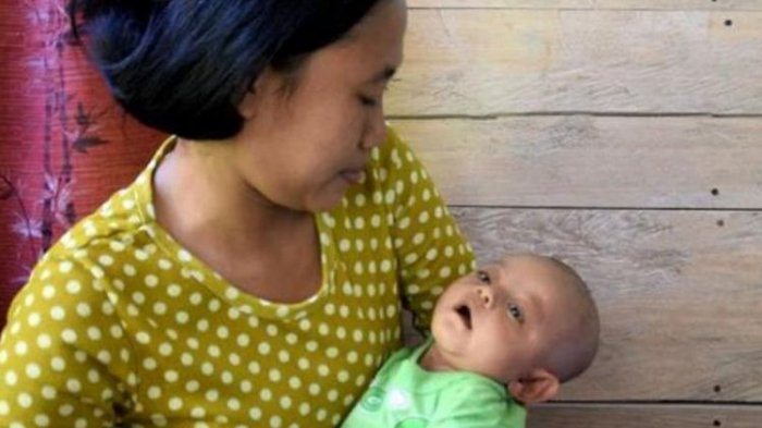 Kena Campak Rubella, Bayi 5 Bulan Ini Buta Dan Tuli, Ibu : Saya Punya ...