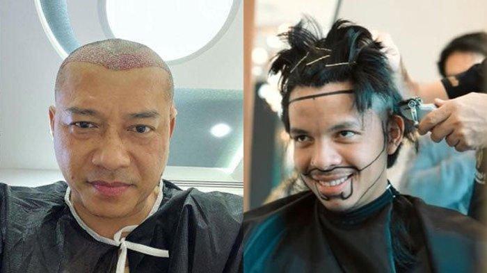 Mengenal Transplantasi Rambut, Mulai dari Proses, Manfaat, dan Efek ...