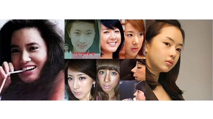 Operasi Plastik Gagal 4 Artis Korea, Model Lawas Ini Kecanduan OP hingga Wajahnya Rusak - Tribun ...