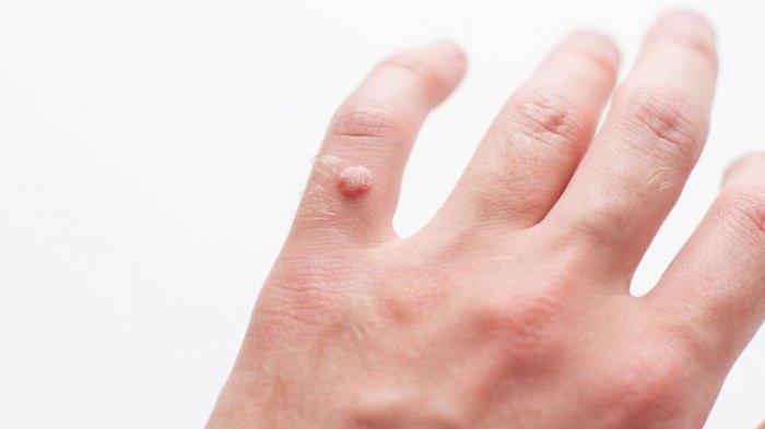 Cara Mengatasi Benjolan Papiloma, Kutil yang Bisa Tumbuh di Daerah ...