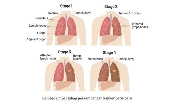 KENALI Penyebab Gejala dan Cara Mengobati Kanker Paru-paru - Tribun-bali.com