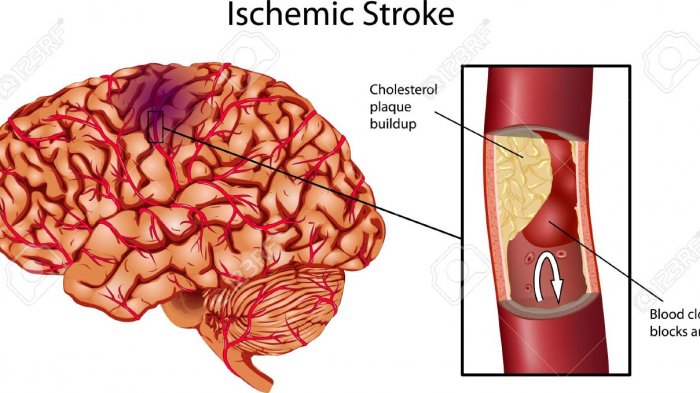 Waspada Gejala Stroke Hemoragik, Salah Satunya Sakit Kepala Mendadak ...