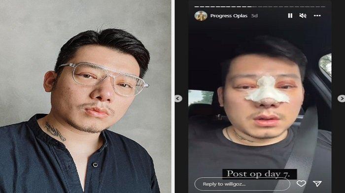 Masih Ingat WIlliam Gozali Juara Masterchef Indonesia? Wajahnya Berubah Usai Operasi Plastik ...