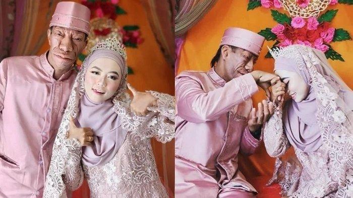 Kisah Surya Manurung, Dulu Viral di TikTok Ngidap Sindrom Treacher ...