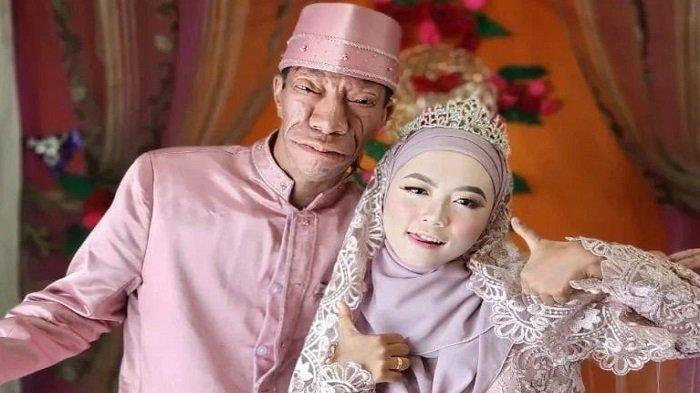 Siapa Surya Manarung? TikTokers Pengidap Sindrom Langka yang Kini Nikahi Gadis Cantik ...