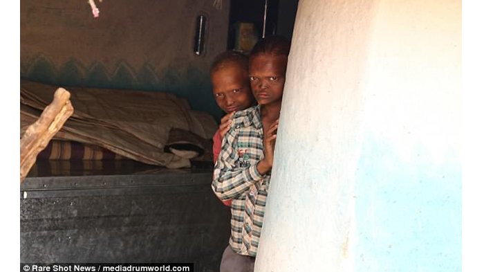 Sering Diejek Hantu, Dua Anak Pemilik Gigi Tajam dan Rambut Tipis Ini ... Sering Diejek Hantu, Dua Anak Pemilik Gigi Tajam dan Rambut Tipis Ini ...