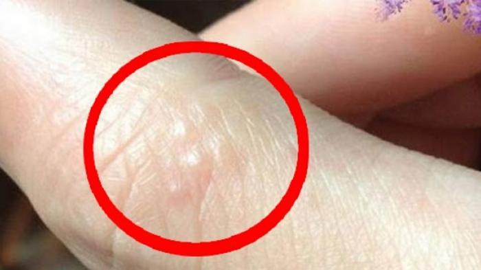 Waspada Jika Ada Tanda Ini Pada Jari Anda - Bangkapos.com