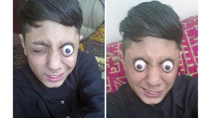 VIDEO: Ngeri! Bola Mata Remaja Ini Seolah Mau Copot - Halaman all ...