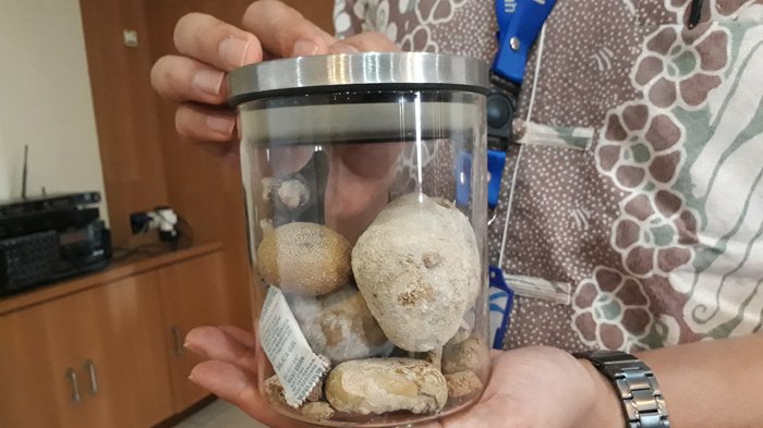 Jangan Sampai Terlambat! Kenali Gejala Penyakit Batu Saluran Kemih ...