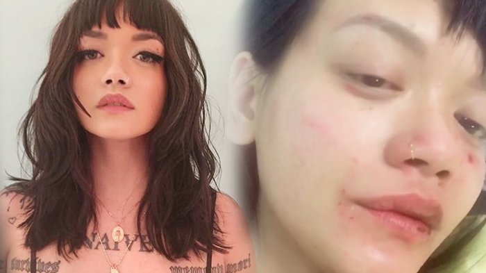 Dylan, Model Indonesia yang Berkarir di AS Dianiaya, Wajah Penuh Luka ...