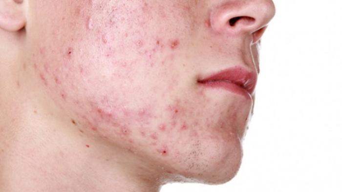 Ini Penyebab Jerawat dan Cara Mengatasinya, Tips Sehat dr Zaidul Akbar ...