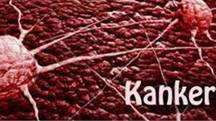 Kanker Mudah Dikenali, Ini Beberapa Tanda-tandanya - Bangkapos.com