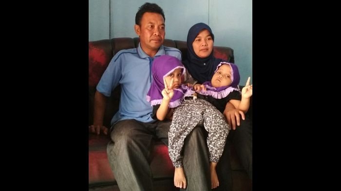 Anak Kembar Siam Asal Garut Ini Tak Bisa Dipisahkan - Bangkapos.com