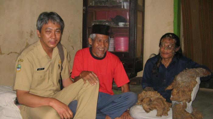 Kisah Dede Manusia Akar Sebelum Meninggal Dunia - Bangkapos.com