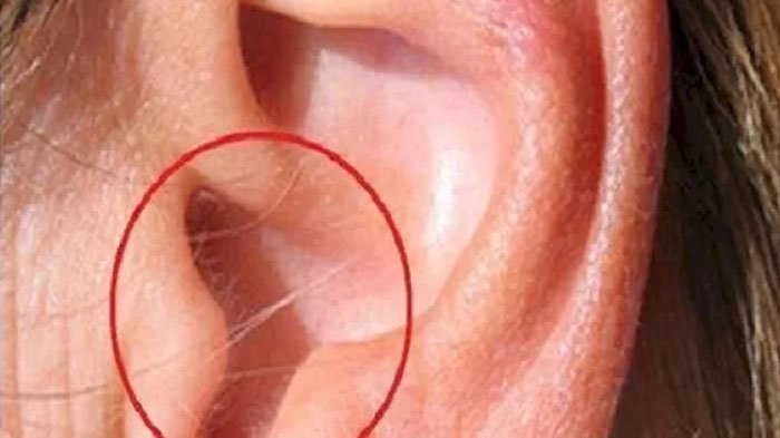 Jangan Anggap Sepele Rambut yang Tumbuh di Telinga, Bisa Jadi Kena ...
