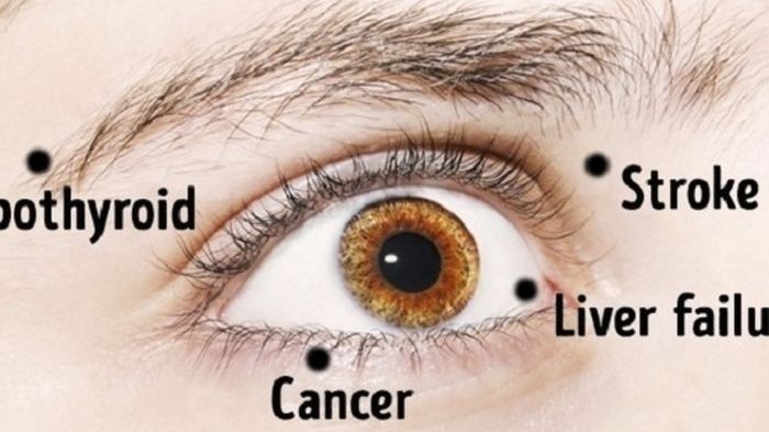 Stres hingga Stroke, Ini Jenis Penyakit yang Tanda-tandanya Bisa ...