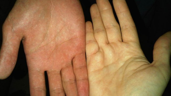 Bisa Dilihat dari Tangan, Kamu Bisa Deteksi Penyakit Berbahaya, Waspada ...