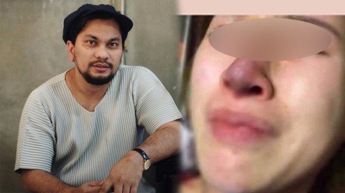 Tompi Ungkapkan Efek Sering Filler Hidung, Tak Bikin Naik Tapi Justru ...