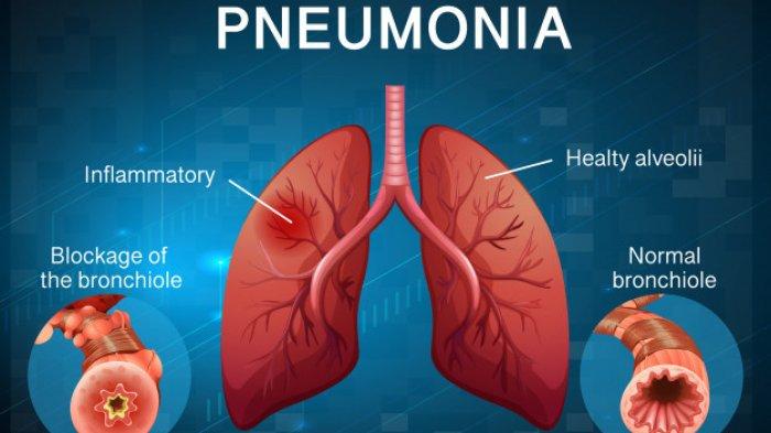 Pentingnya Mengenali 8 Gejala Paru-paru Basah - Bangkapos.com