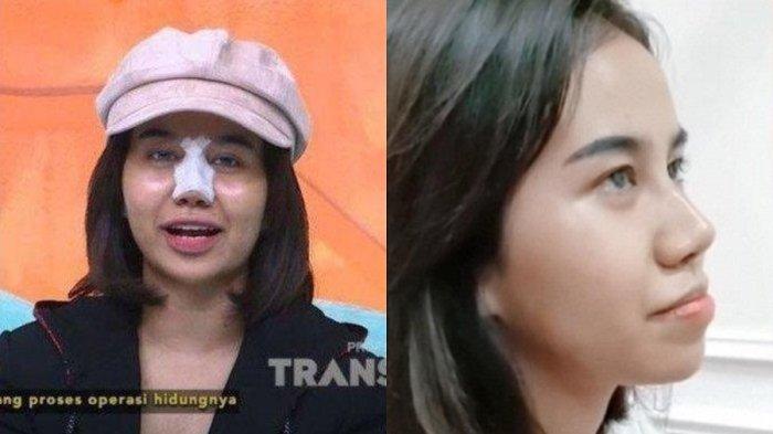Sukses Bikin Pangling, Ini Penampakan Wajah Baru Mayang usai Operasi Hidung, Makin Mancung ...