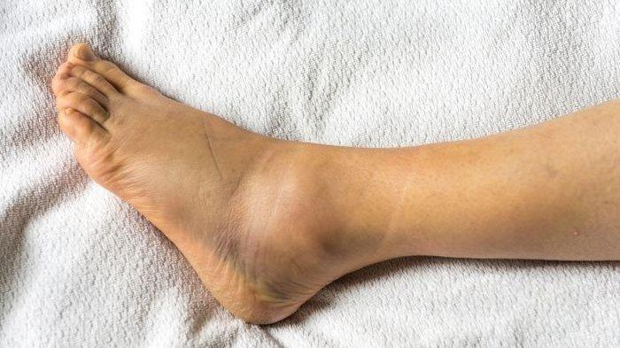Ketahui Penyebab Kaki Bengkak dan Cara Mengatasi secara Mudah Sederhana ...