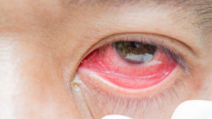 Ketahui Perbedaan Mata Merah karena Gejala Covid Arcturus dan Iritasi ...