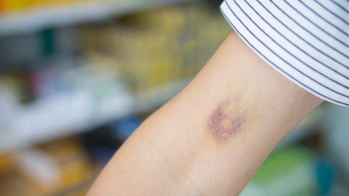 8 Tanda Trombosit Turun yang Pantang Diabaikan, Waspada bila Mudah ...