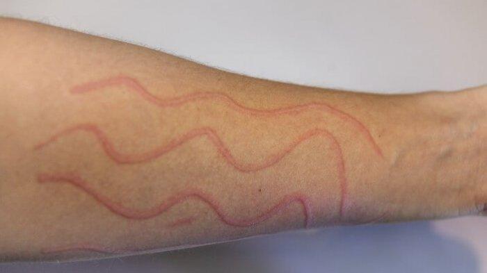 Mengenal Dermatographia, Munculnya Tonjolan di Kulit Setelah Tergores ...
