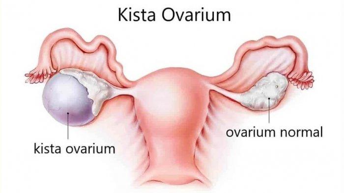 Mengenal Kista Ovarium yang Sebabkan Kiky Saputri Keguguran, Begini Cara Mencegahnya ...