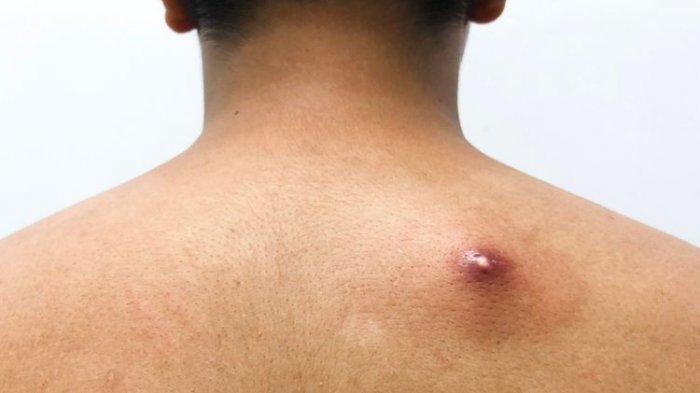 Gejala dan Penyebab Munculnya Bisul, Jangan Dipencet dengan Sengaja ...
