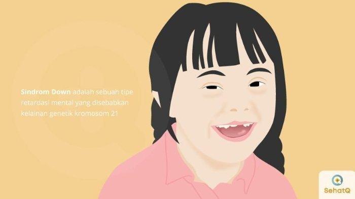 Mengenal Penderita Down Syndrome, Berikut Penyebab Hingga Bentuk Kelainan Fisik yang Khas ...
